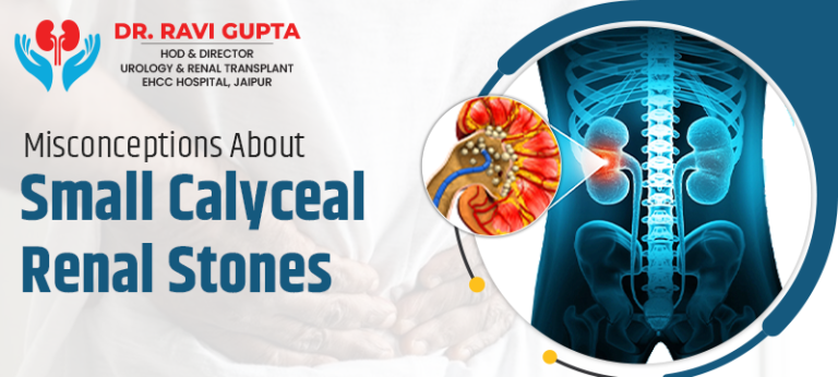 Debunking Myths: Understanding Small Calyceal Renal Stones